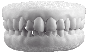 Vivid Aligners – Perfect Finish Ortho Lab Inc.