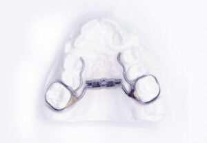 Fixed Appliances - Perfect Finish Ortho Lab