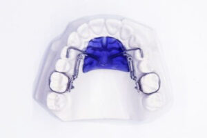 Fixed Appliances - Perfect Finish Ortho Lab